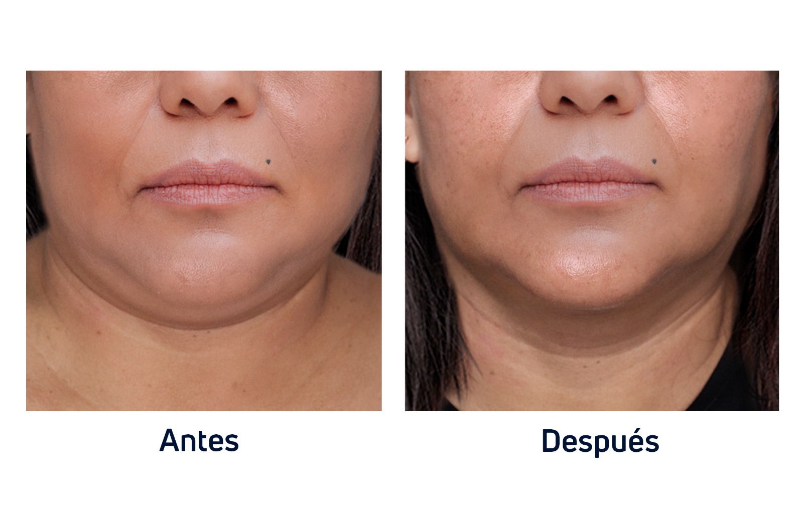 Liposucción de Papada